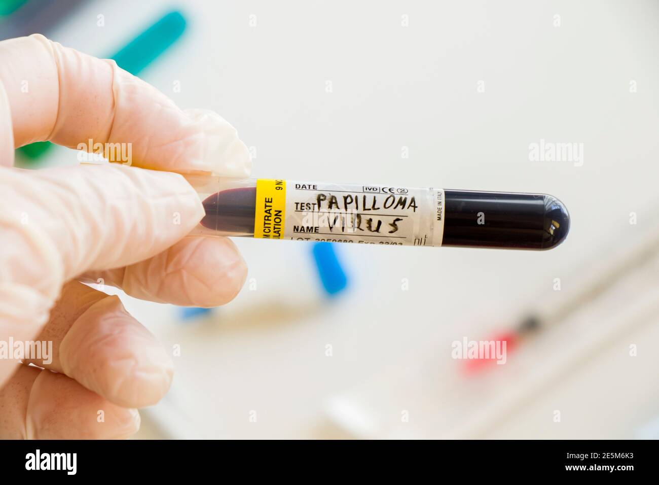 Papilloma virus blood test tube sample on the white background in the ...