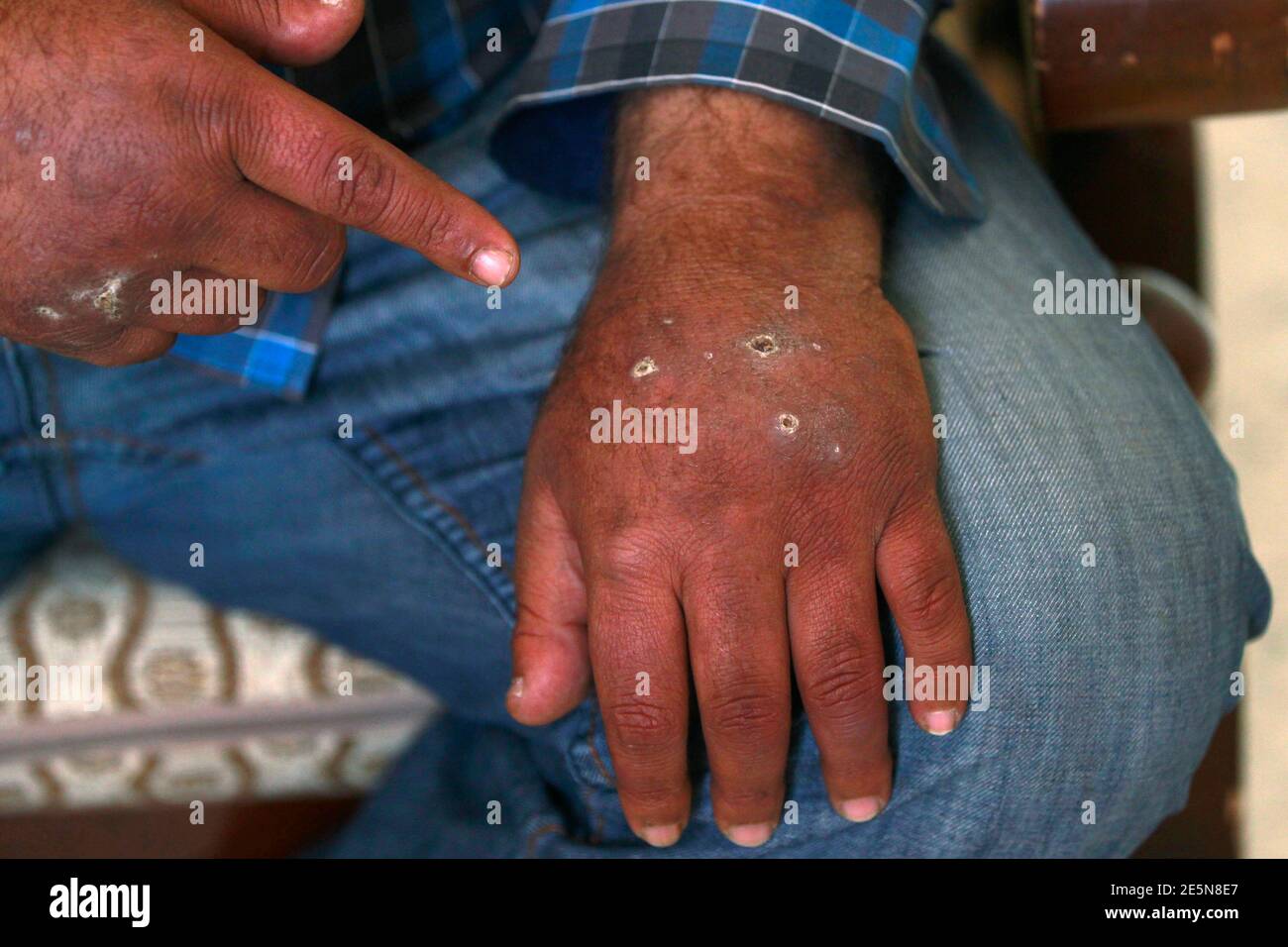 Heroin Addict Track Marks