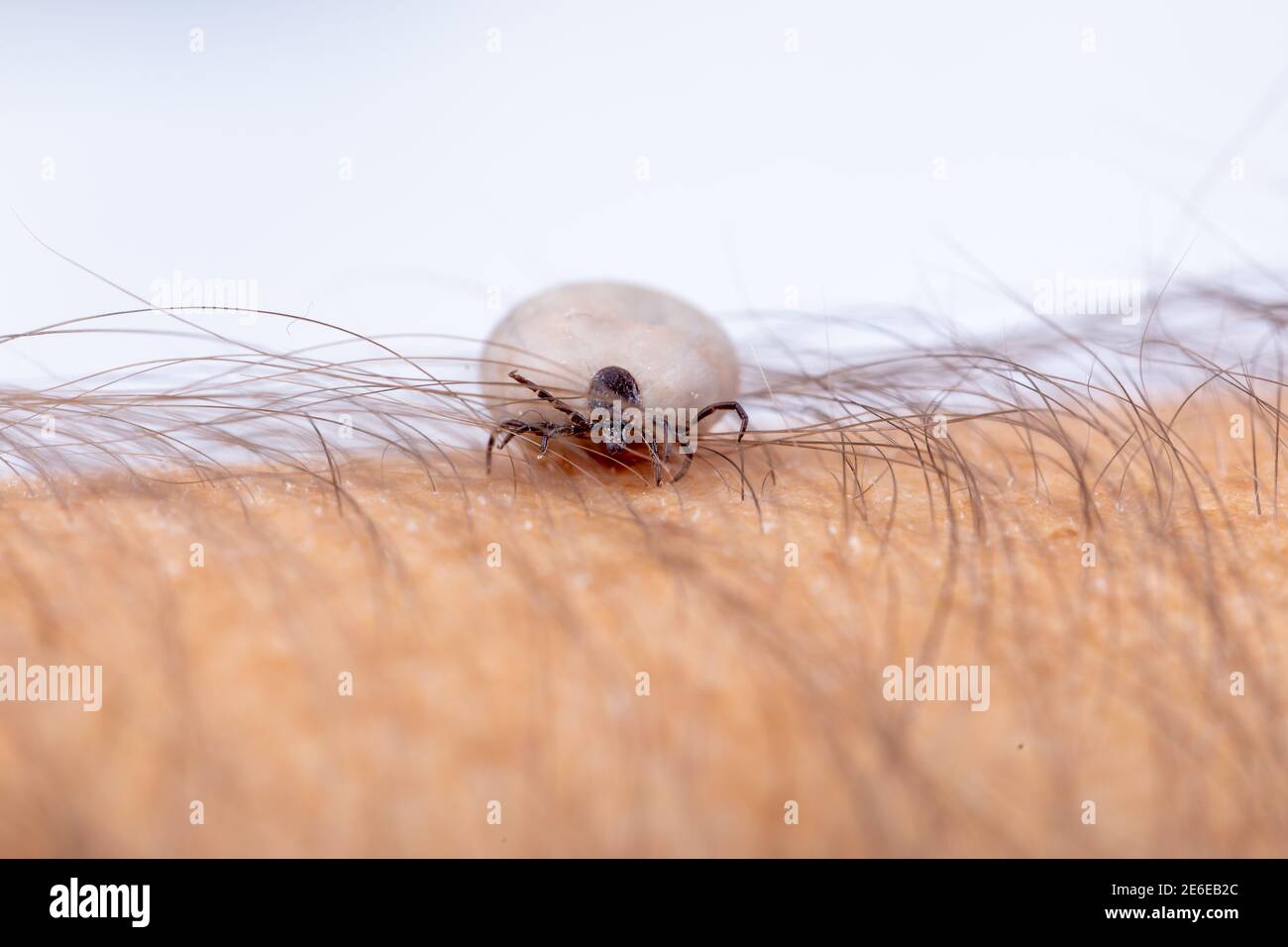 Tick (Ixodes ricinus) on human skin filled with blood. Danger insect ...