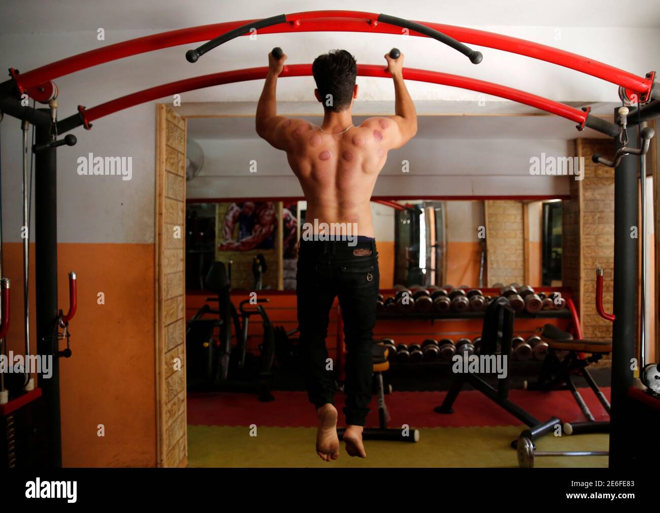 Cupping therapy athletes hi-res stock photography and images - Alamy