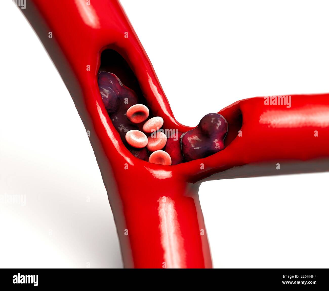 Ischemic stroke. Thrombus, blood clot in the veins, artery occlusion ...