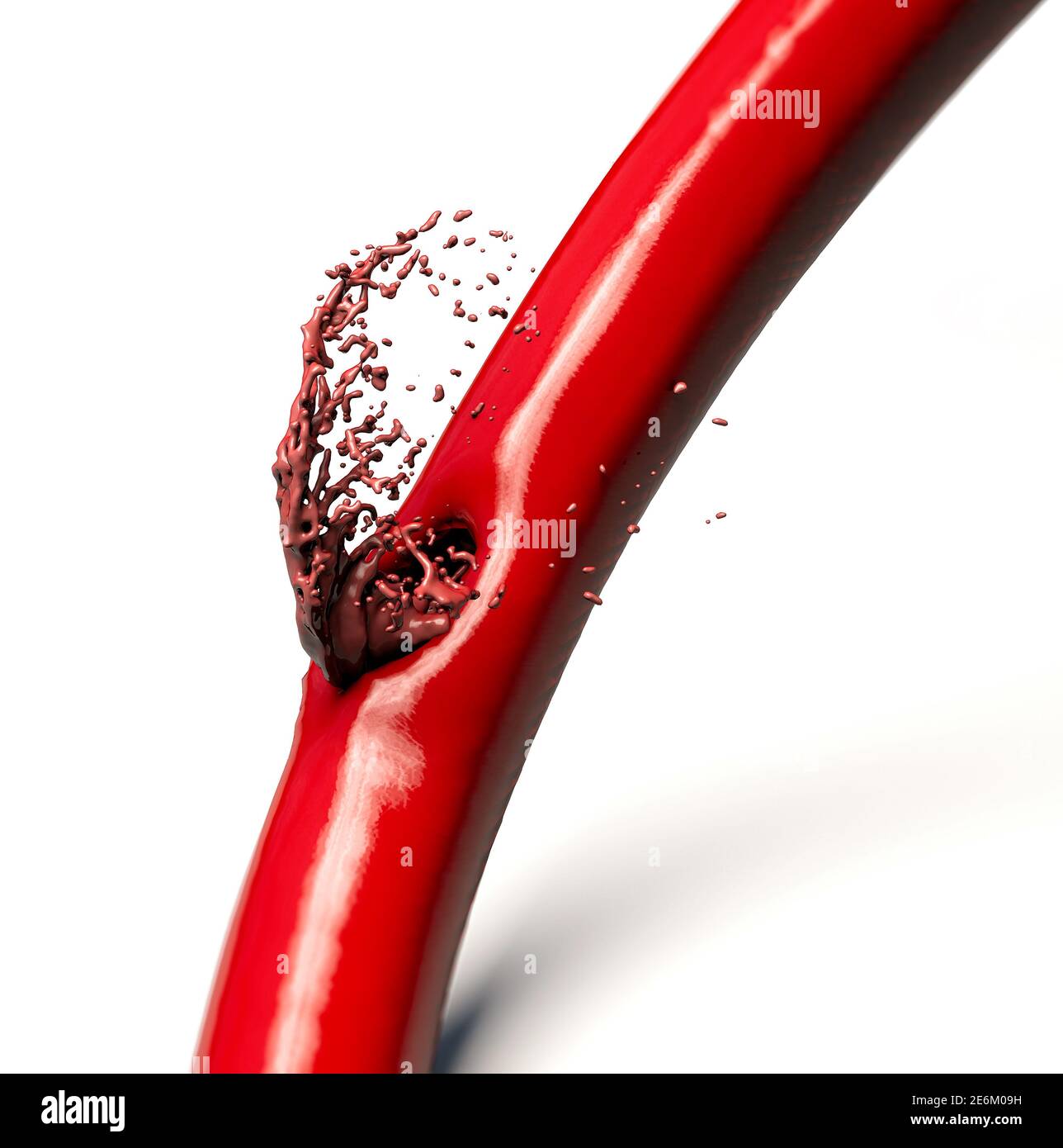 Hemorrhagic stroke. An artery ruptures, causing more or less extensive ...