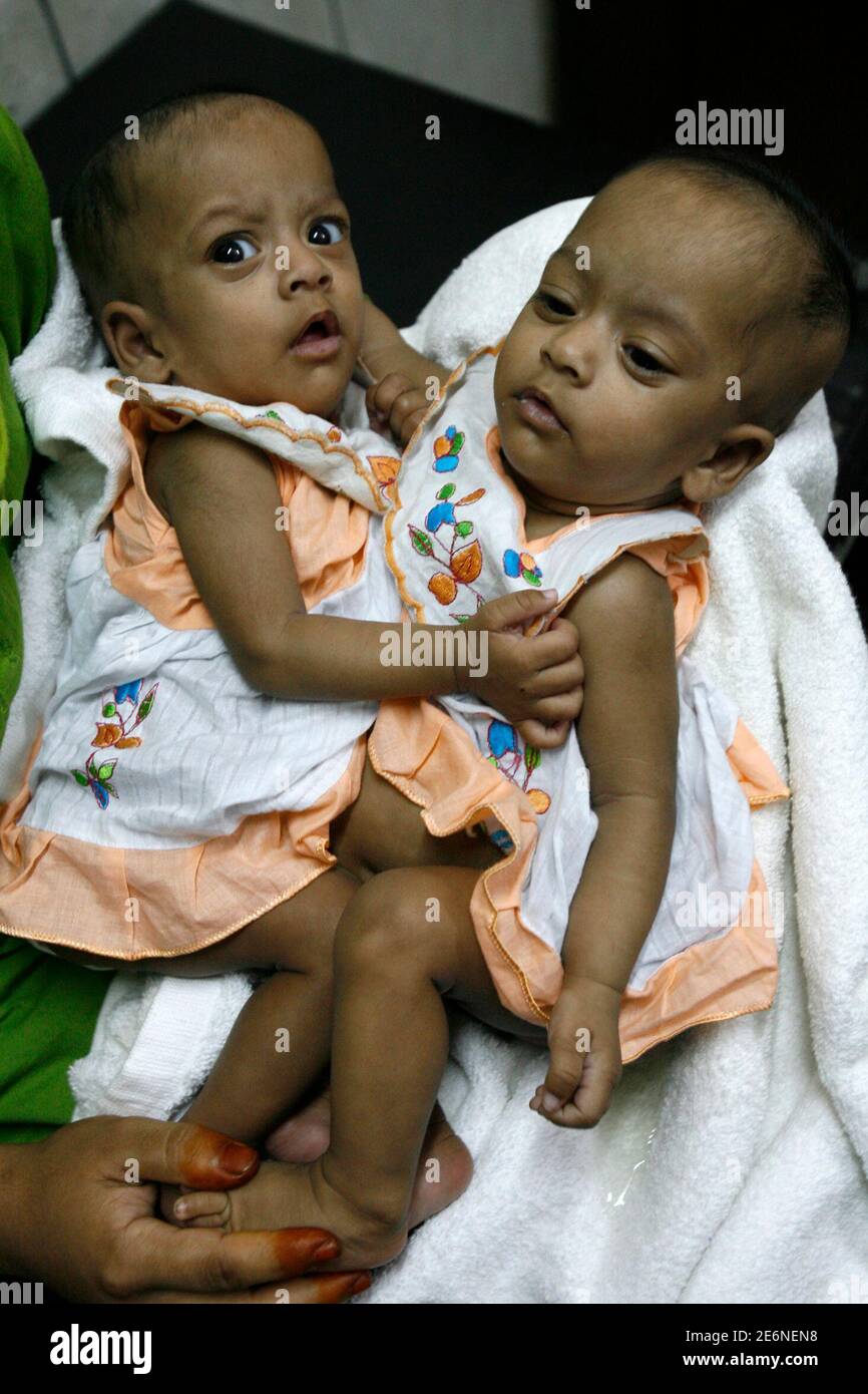 Conjoined twins born hi-res stock photography and images - Alamy