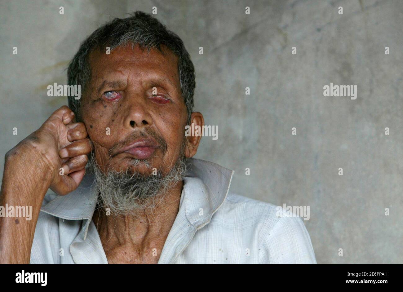 Leprosy medicine hi-res stock photography and images - Alamy