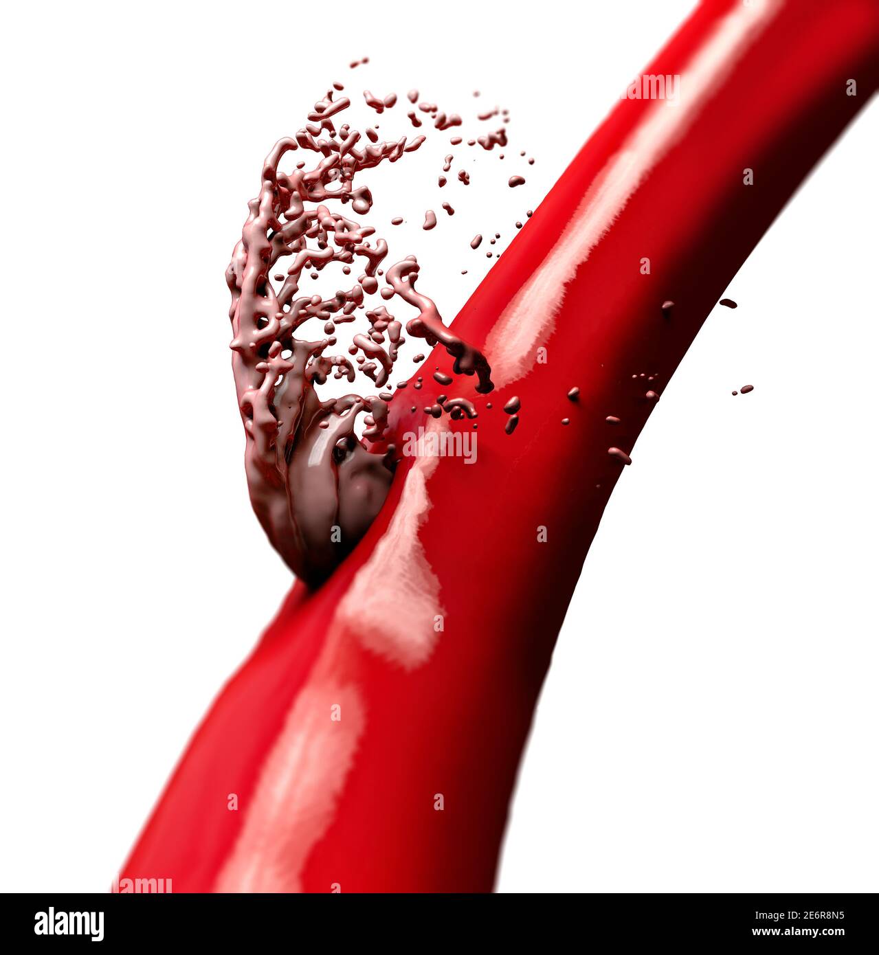 Hemorrhagic stroke. An artery ruptures, causing more or less extensive ...