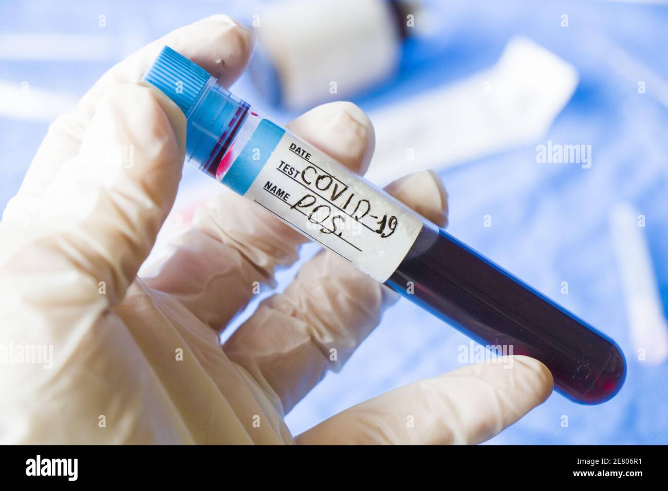 High angle shot of a blood test sample with positive result in a doctor ...