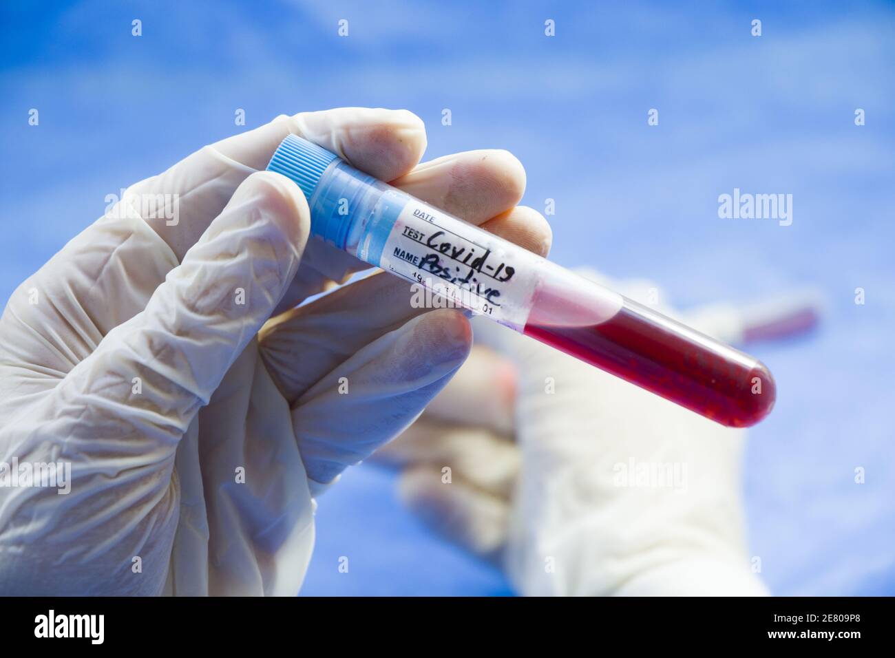 High angle shot of a blood test sample with positive result in doctor ...