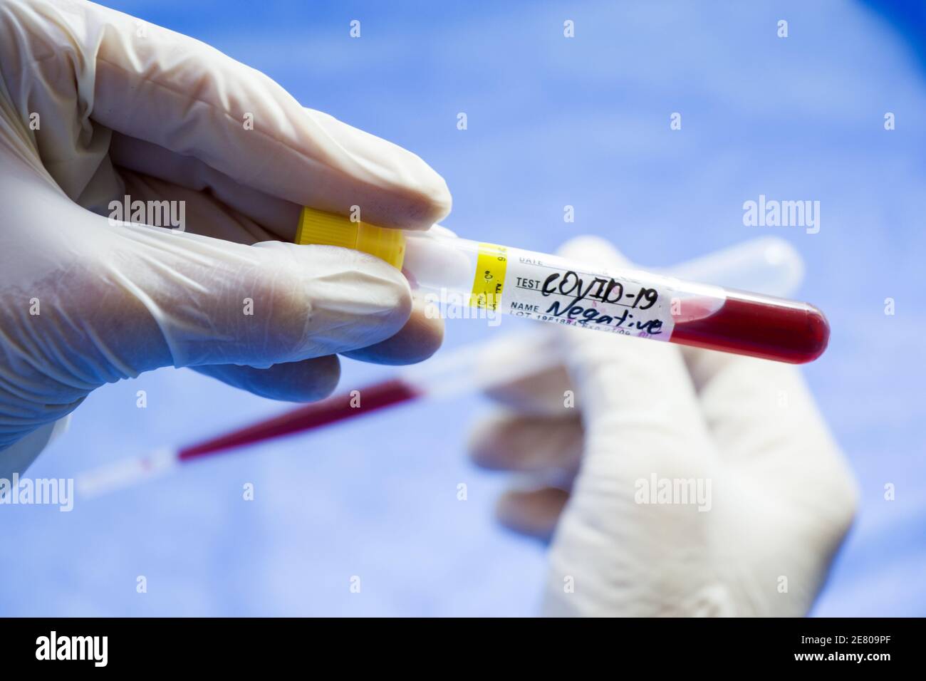 High angle shot of a blood test sample with negative result in doctor ...