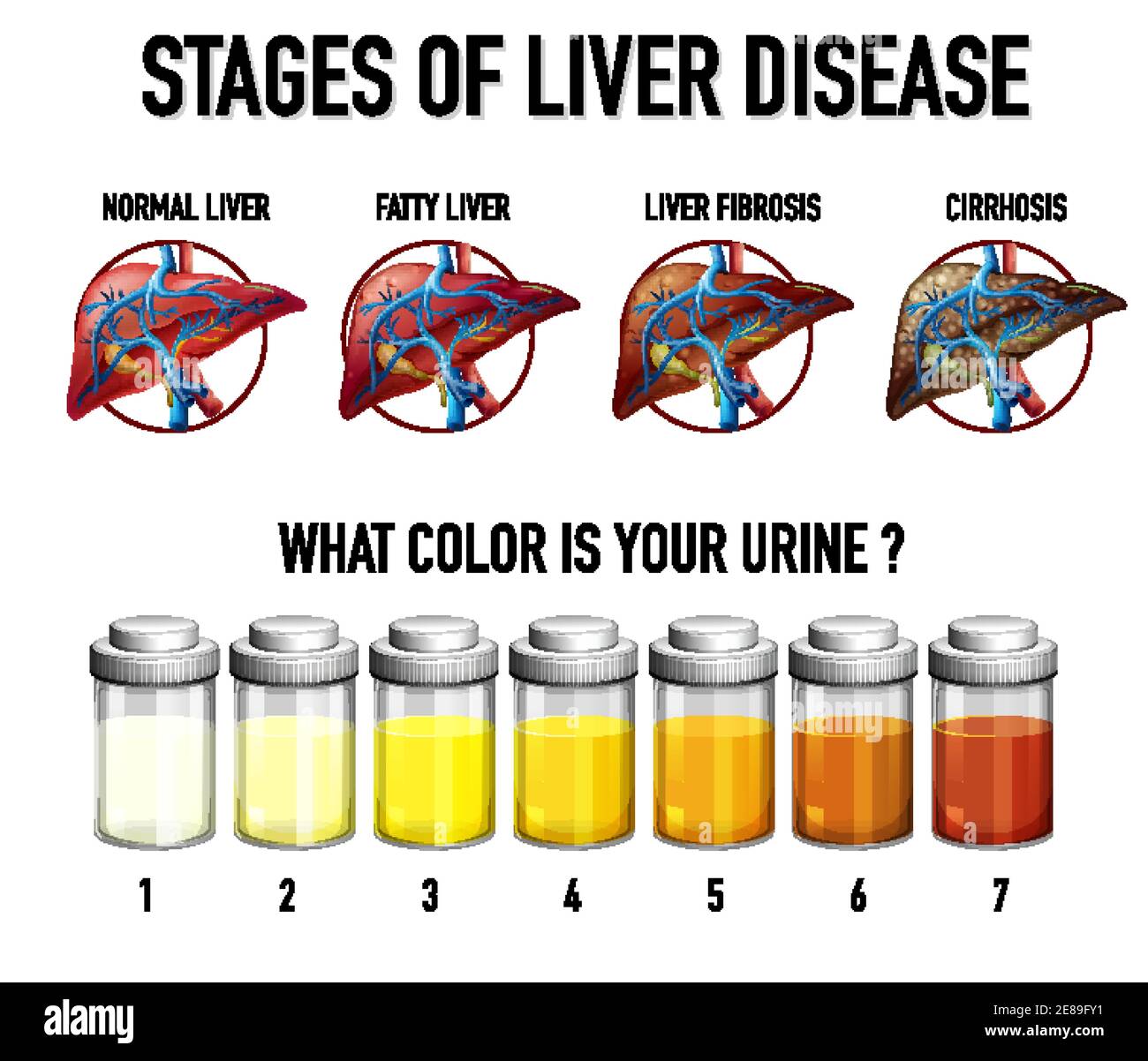 Stages of liver disease illustration Stock Vector Image & Art - Alamy