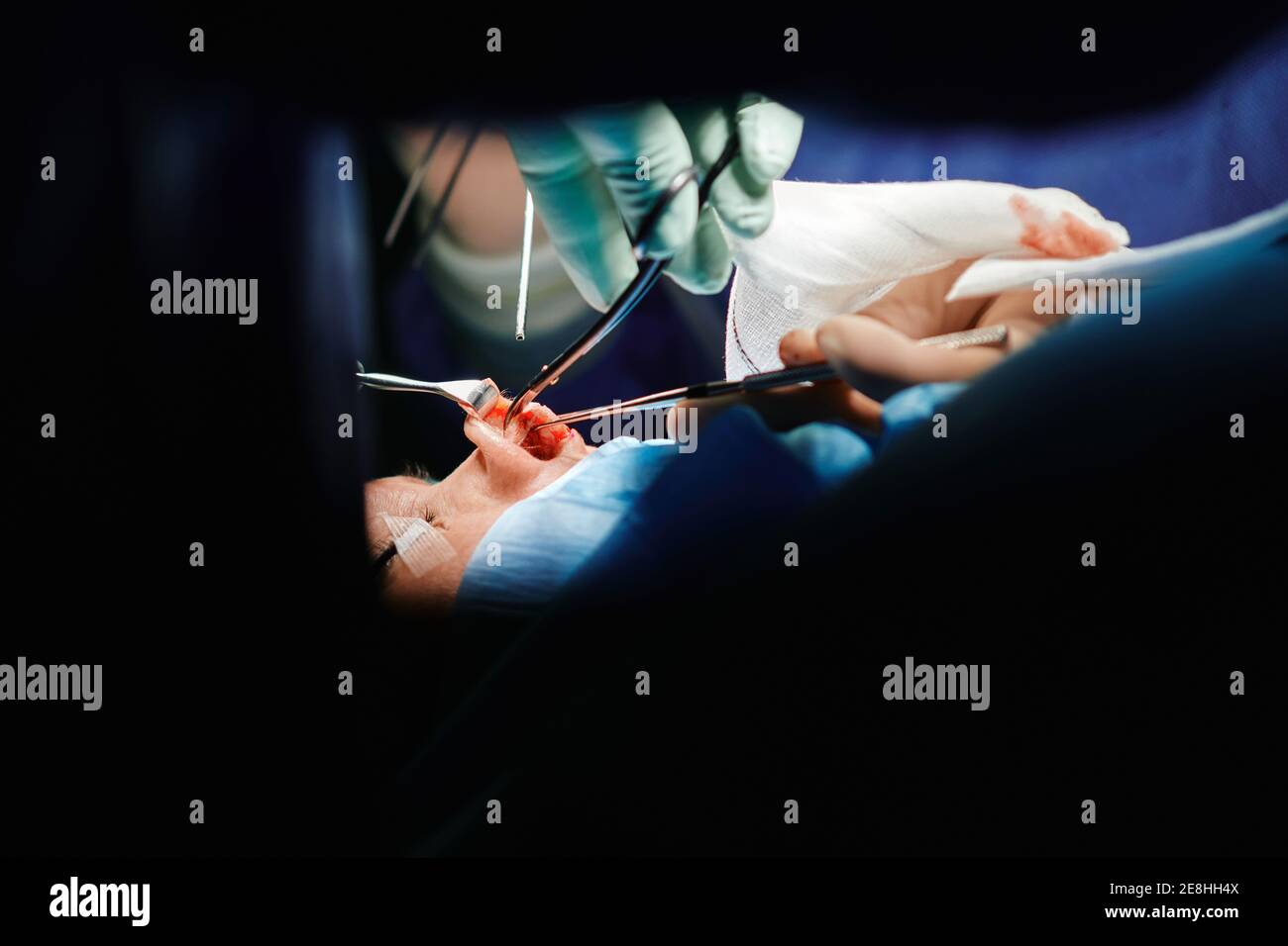 Suturing wound hi-res stock photography and images - Alamy