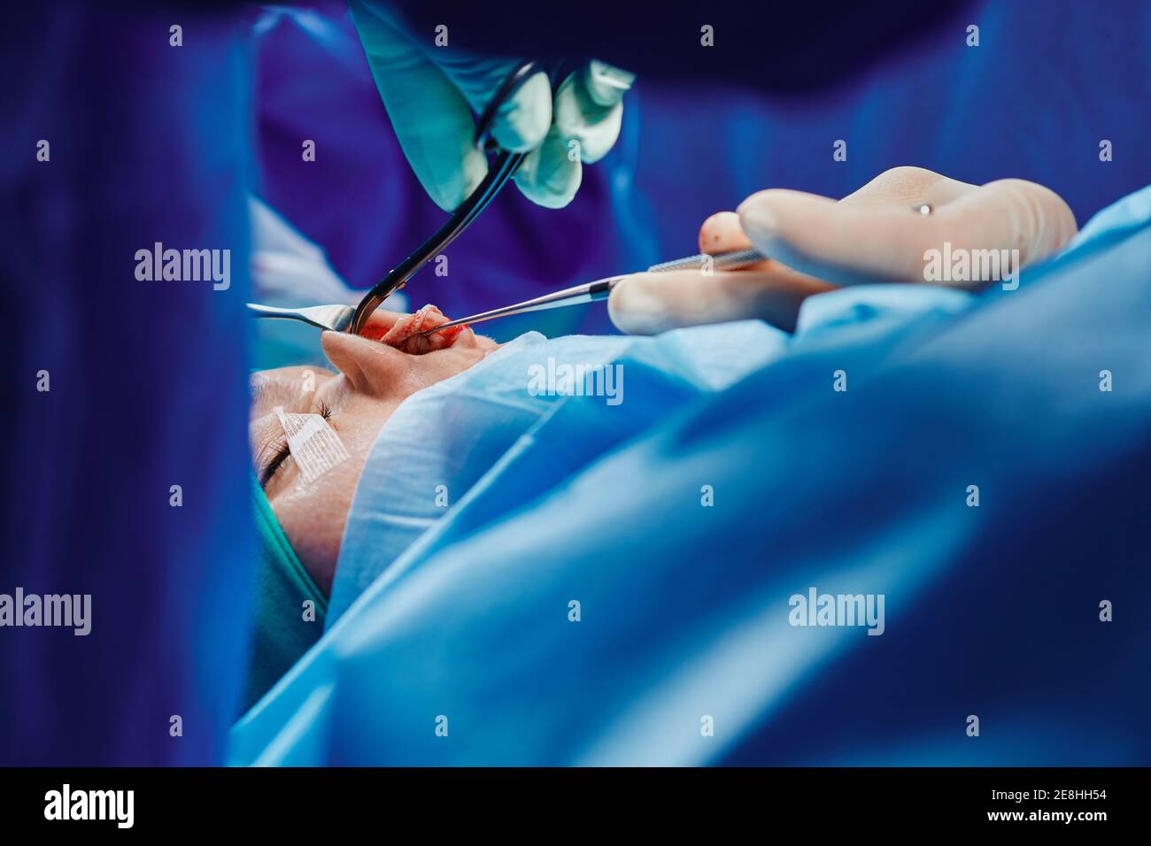 Suturing wound hi-res stock photography and images - Alamy