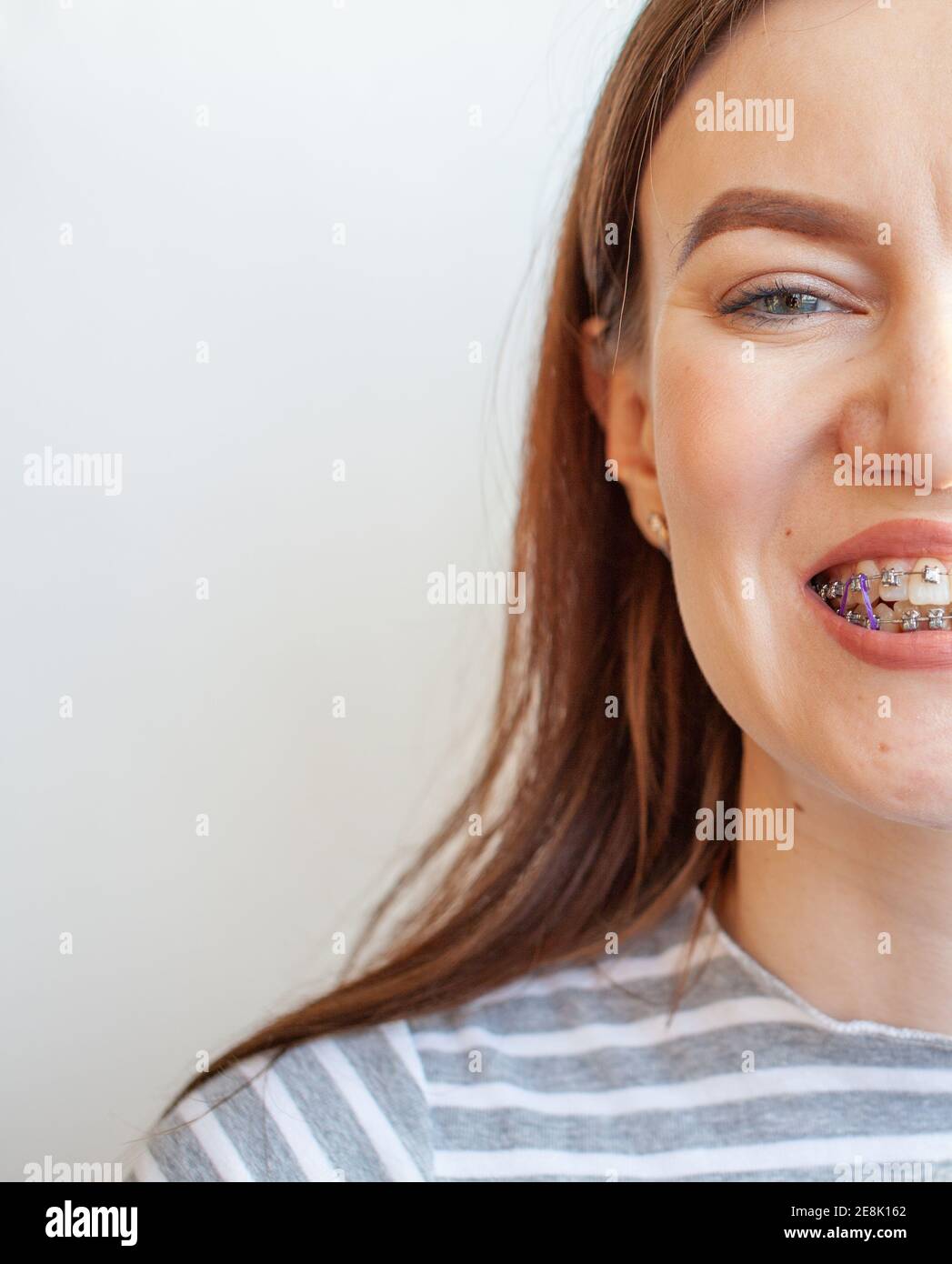 Braces in the smiling mouth of a girl. Close-up photos of teeth and ...