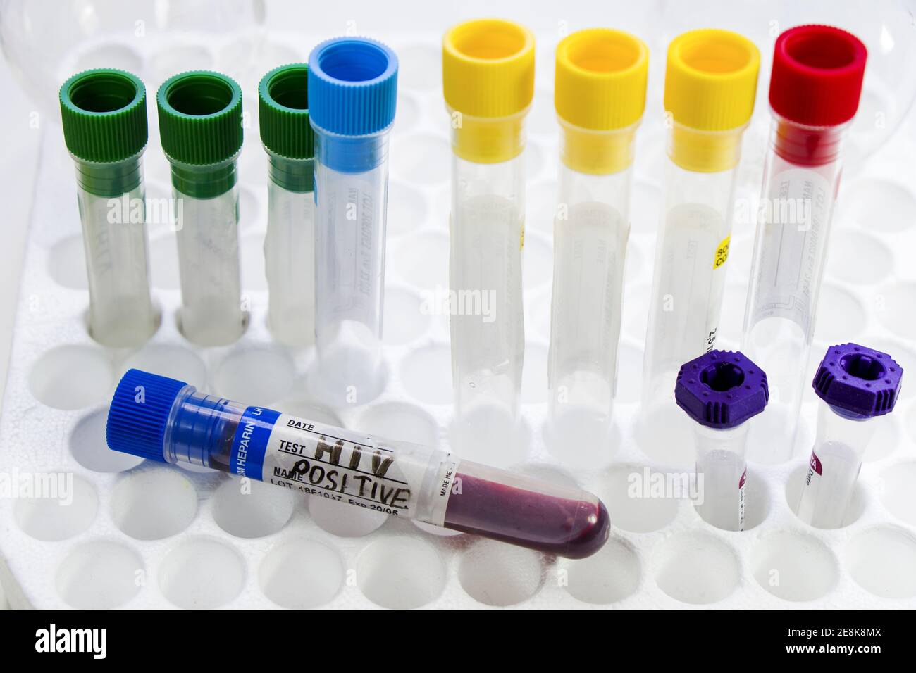 An isolated shot of blood test tubes and one with positive result on ...