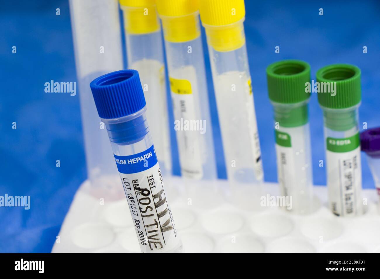 A high angle shot of empty blood test sample tube with positive result ...
