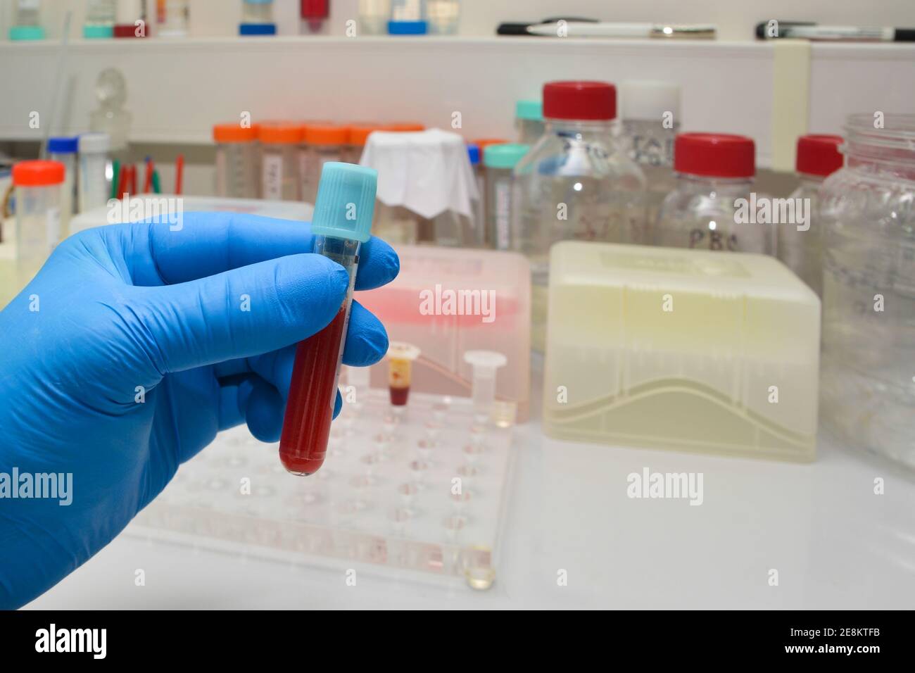 Laboratory blood test. Blood sample in hand against the background of ...