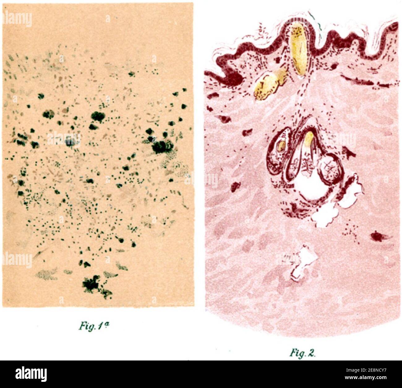 Morbus Cut Out Stock Images & Pictures - Alamy