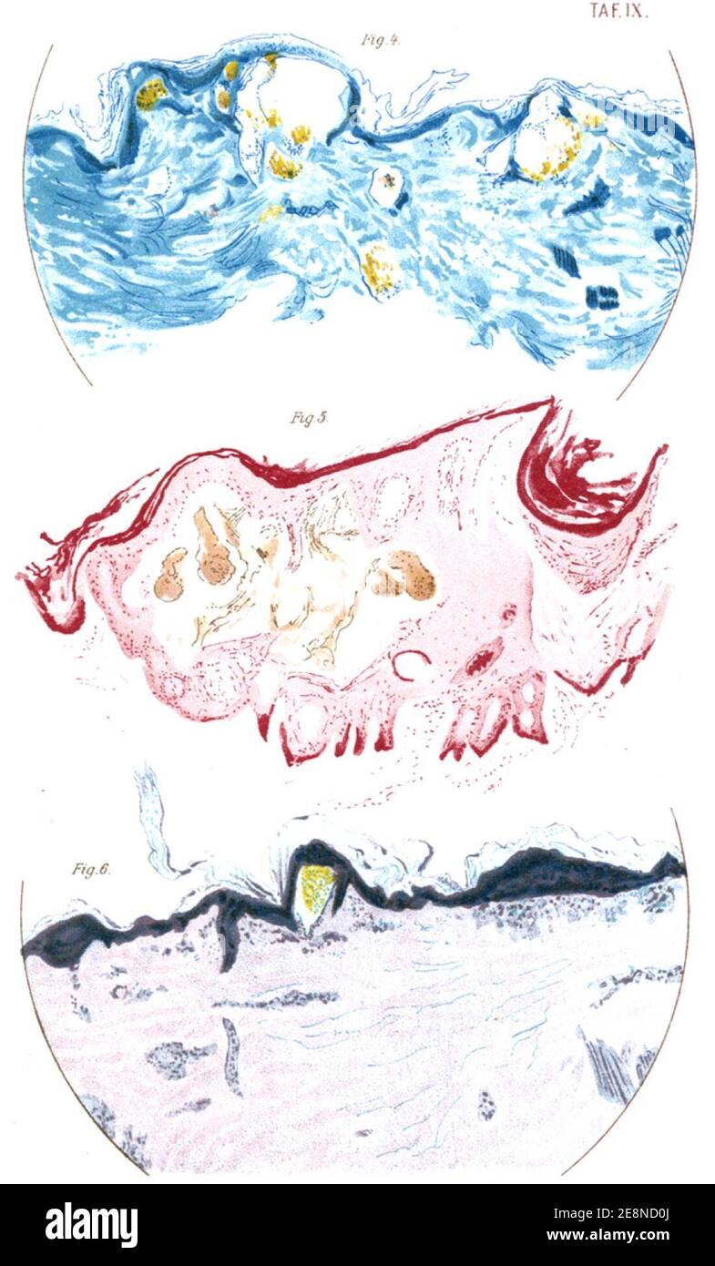 Morbus Fabry Emil Honke 1898 03 Stock Photo - Alamy