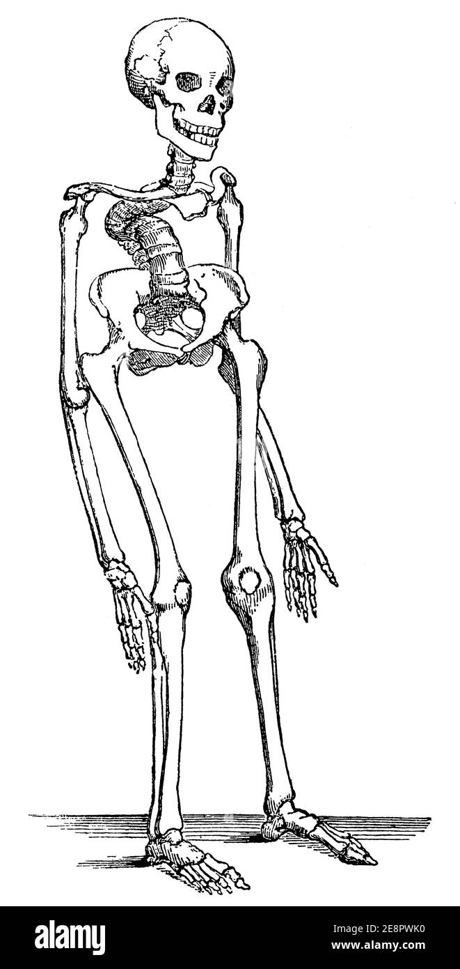 Human skeleton with rickets. Illustration of the 19th century. Germany ...