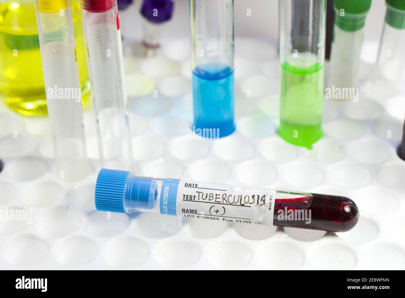 Closeup shot of a tube for a tuberculosis test in the laboratory Stock ...