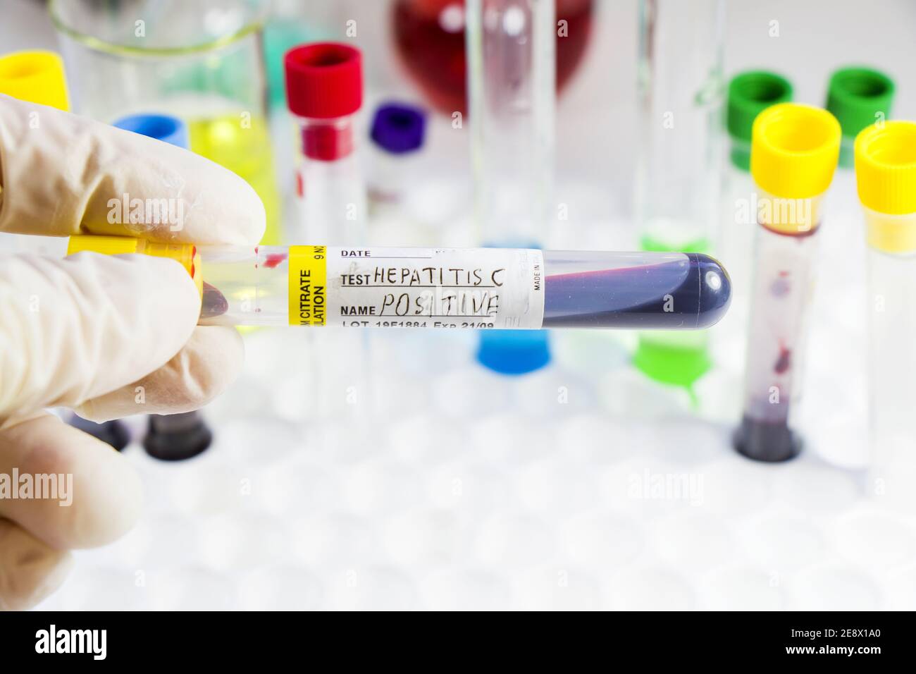 Closeup shot of a tube for hepatitis C test in the laboratory Stock ...