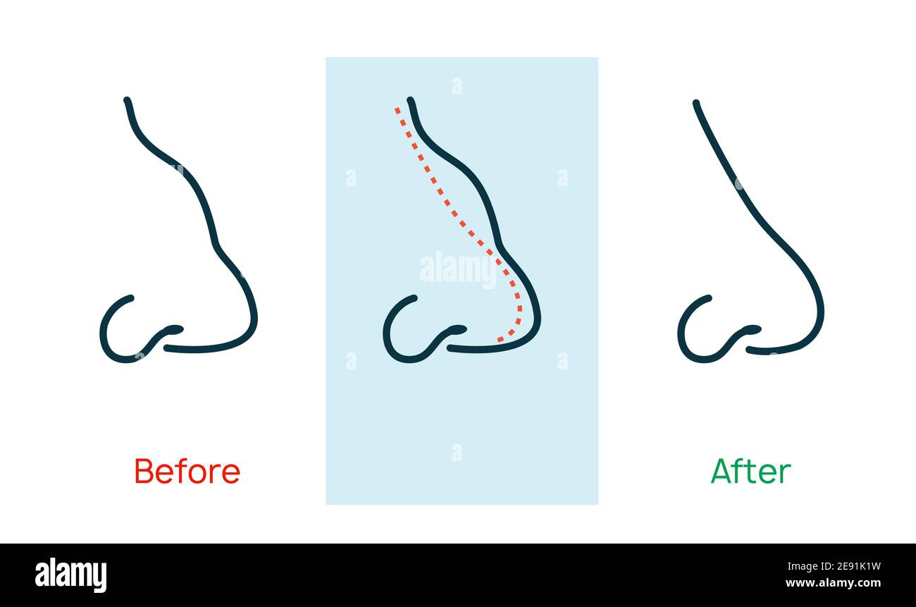 Rhinoplasty nose plastic surgey icon. Vector rhinoplasty beauty icon ...