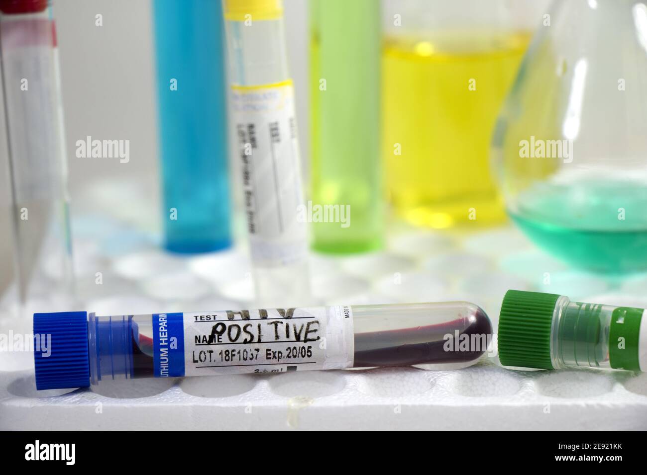 Closeup shot of HIV positive blood specimen on a test tube in the ...