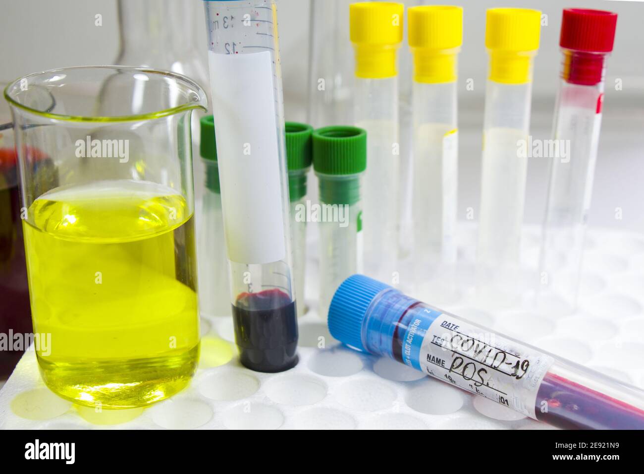 Positive COVID-19 blood test specimen with laboratory chemical liquid ...
