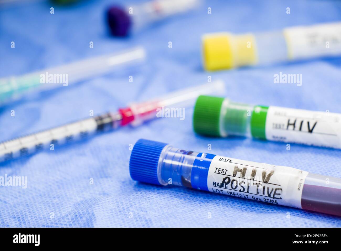 Selective focus shot of positive HIV blood specimen on test tube in the ...