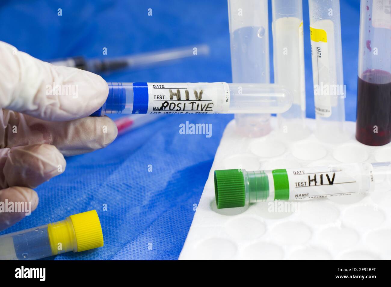 Hand in glove holding positive HIV blood specimen on test tube in the ...