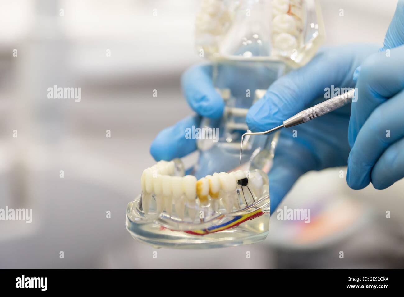 Closeup of dentist holding teeth model denture, showing what pulpitis ...