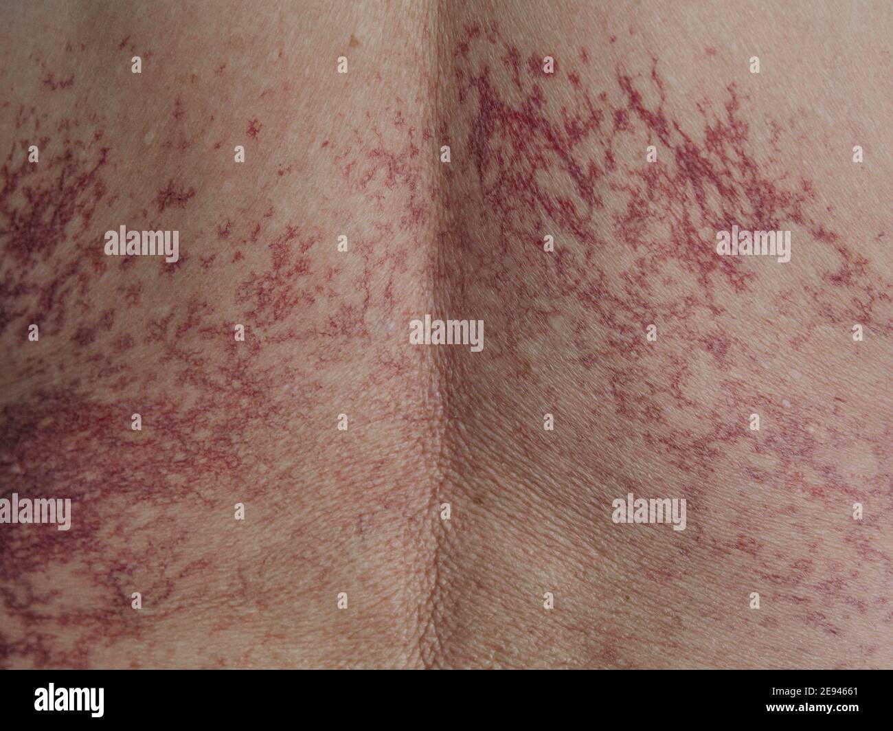 Closeup shot of human skin with red rashes Stock Photo - Alamy