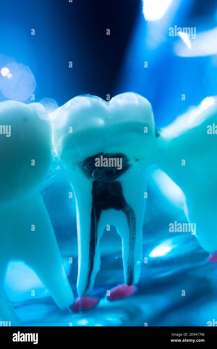 tooth decay going to root canal in teeth teaching medical model Stock ...