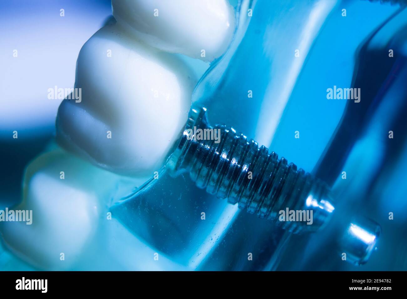 Dental tooth metal implant dentistry teaching model showing teeth and ...