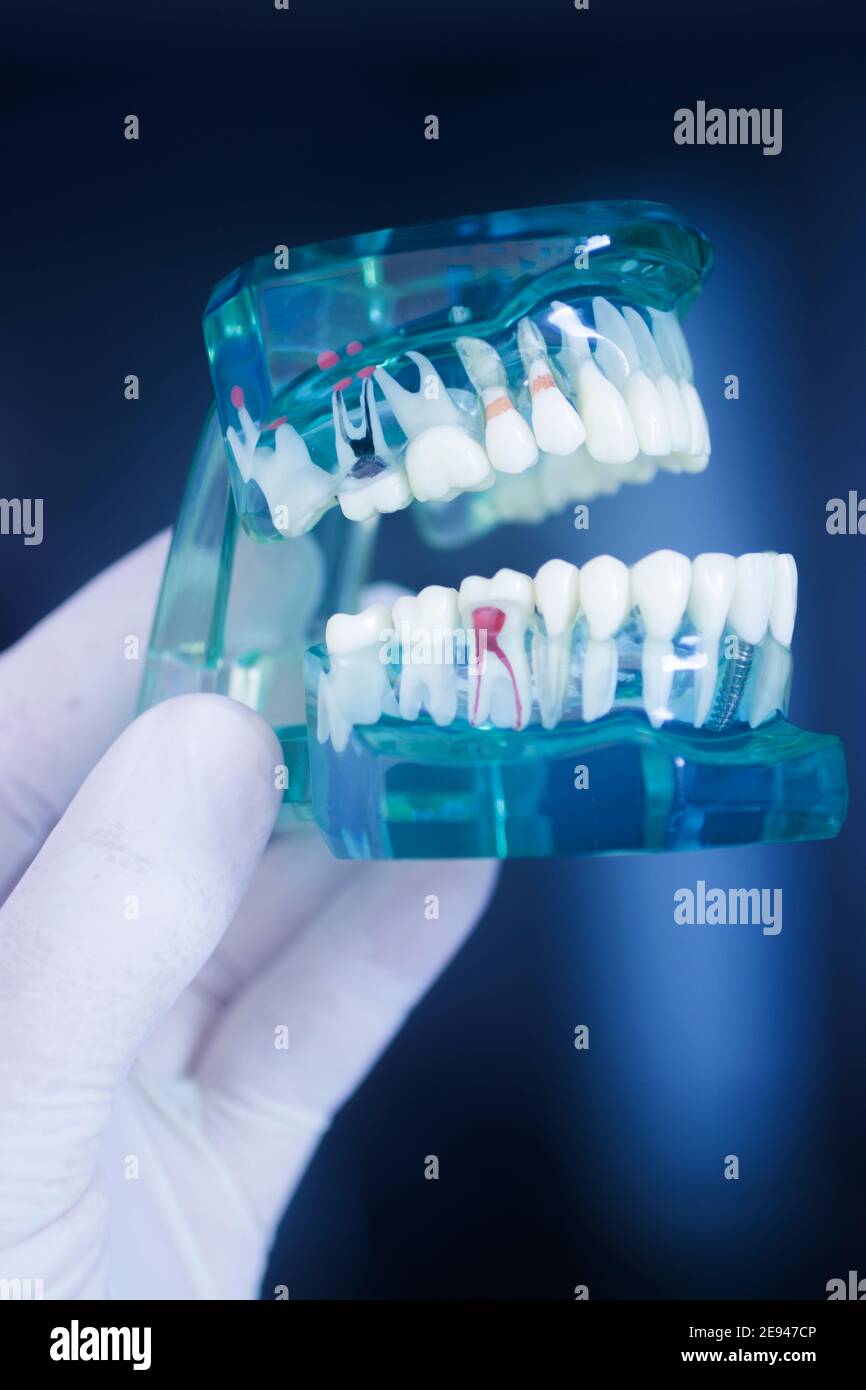 Teeth decay dentistry model showing caries in tooth Stock Photo - Alamy