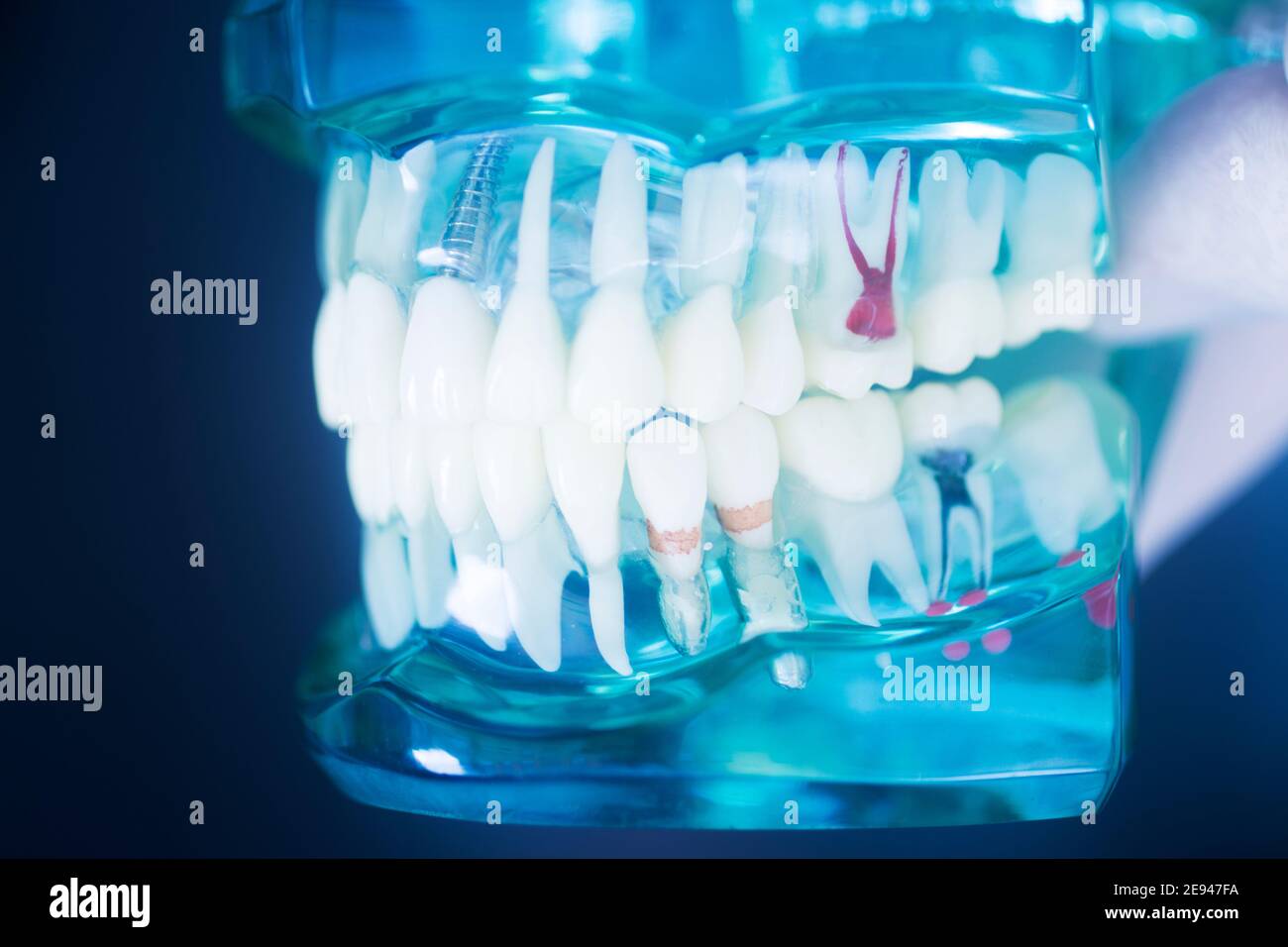 Teeth decay dentistry model showing caries in tooth Stock Photo - Alamy
