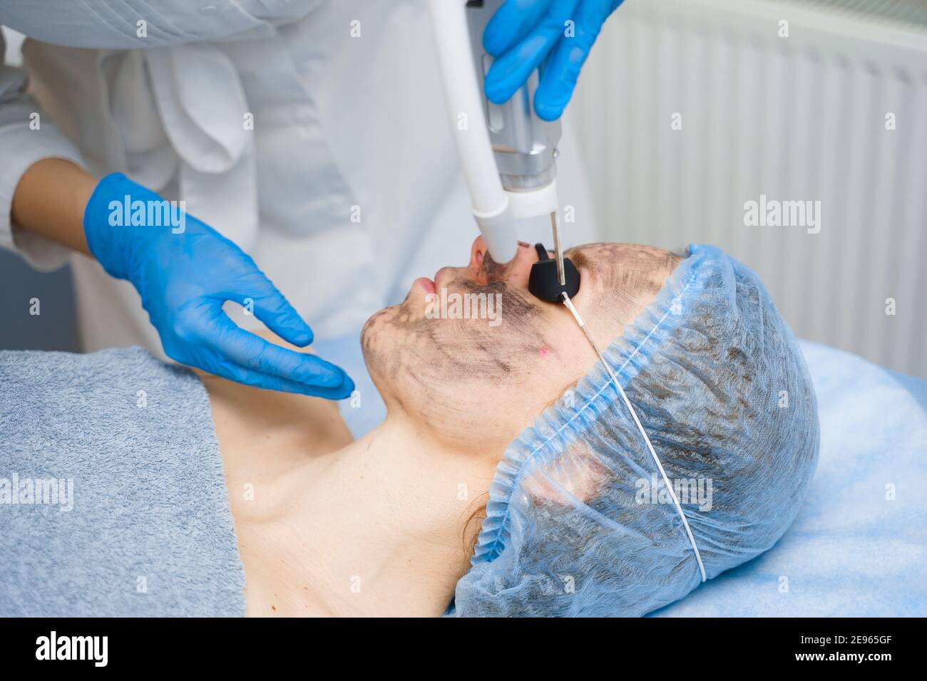 Laser photorejuvenation and carbon peeling of face for woman. Black ...