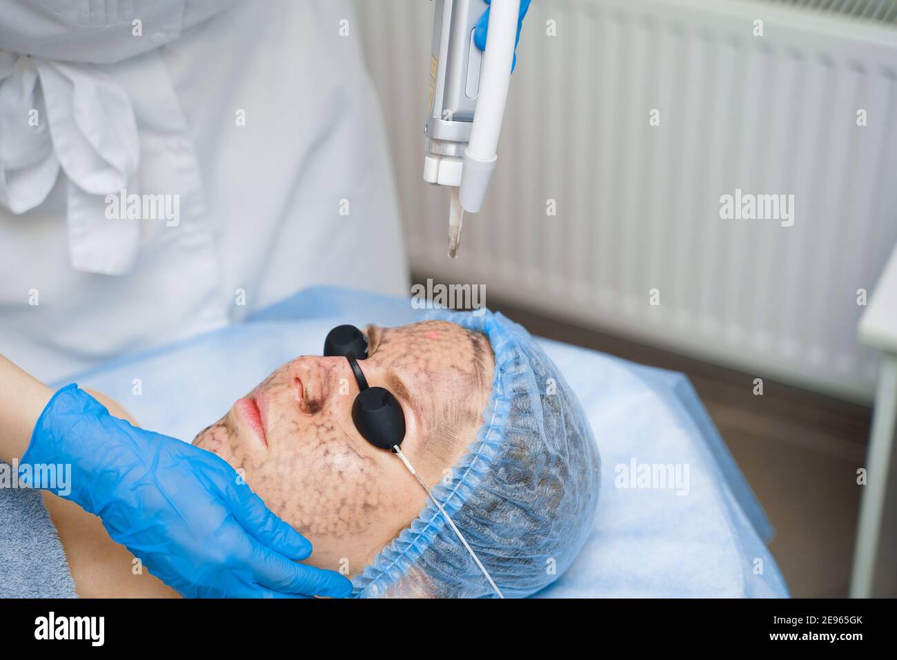 Laser photorejuvenation and carbon peeling of face for woman. Black ...