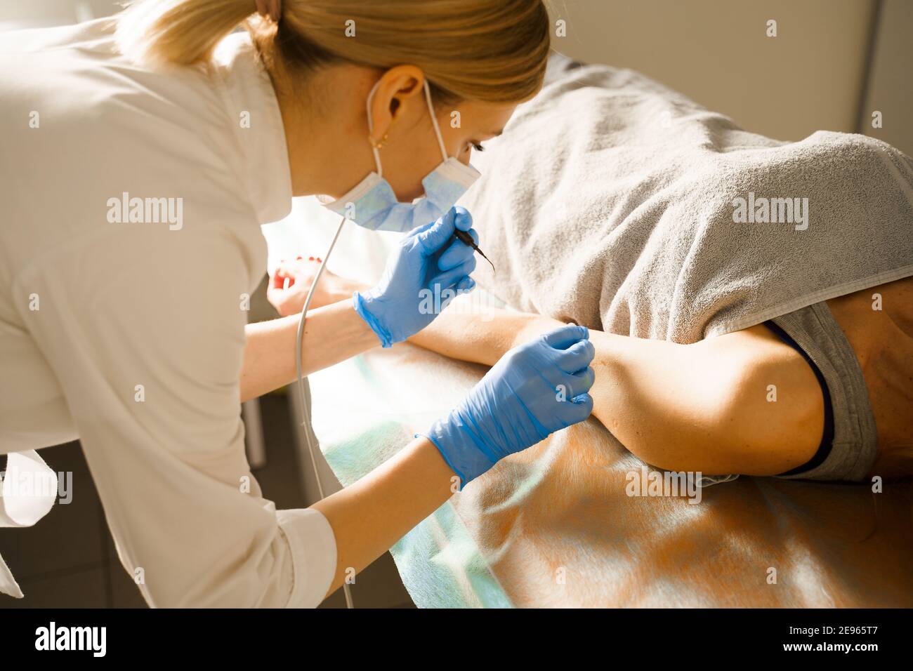 Papillomas removal on hand using radio wave. Rejuvenation cosmetology ...