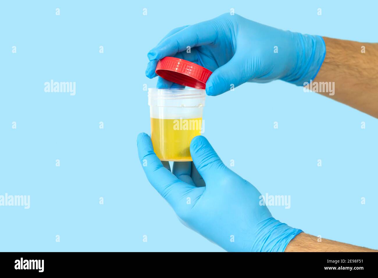 Nurse opening urine sample container for medical urinalysis. Healthcare ...