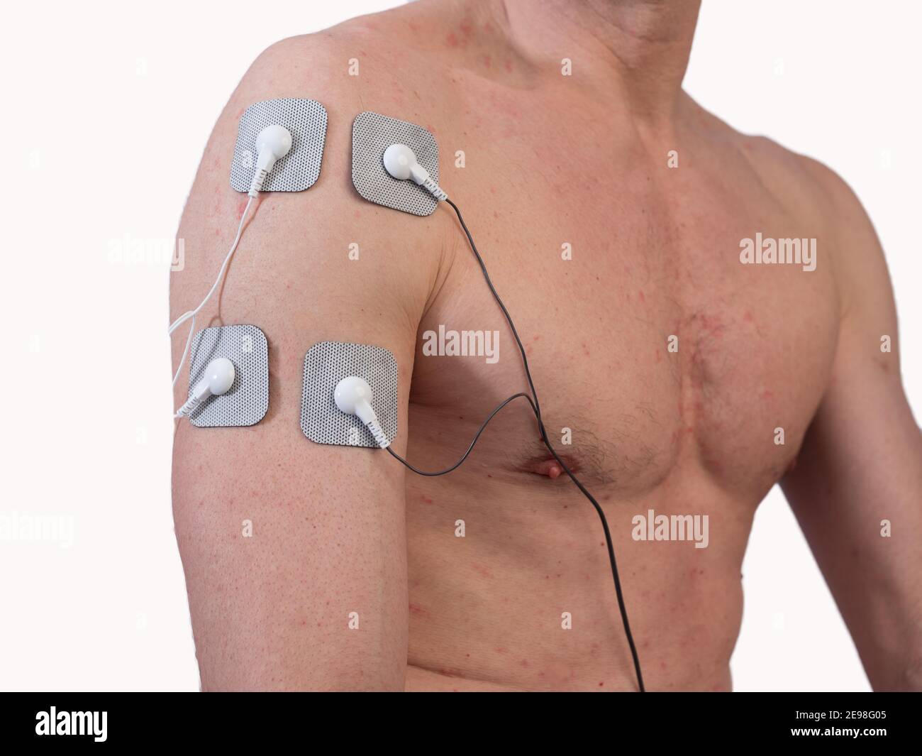 Close-up Of Person With Electrodes On Shoulder Stock Photo - Alamy