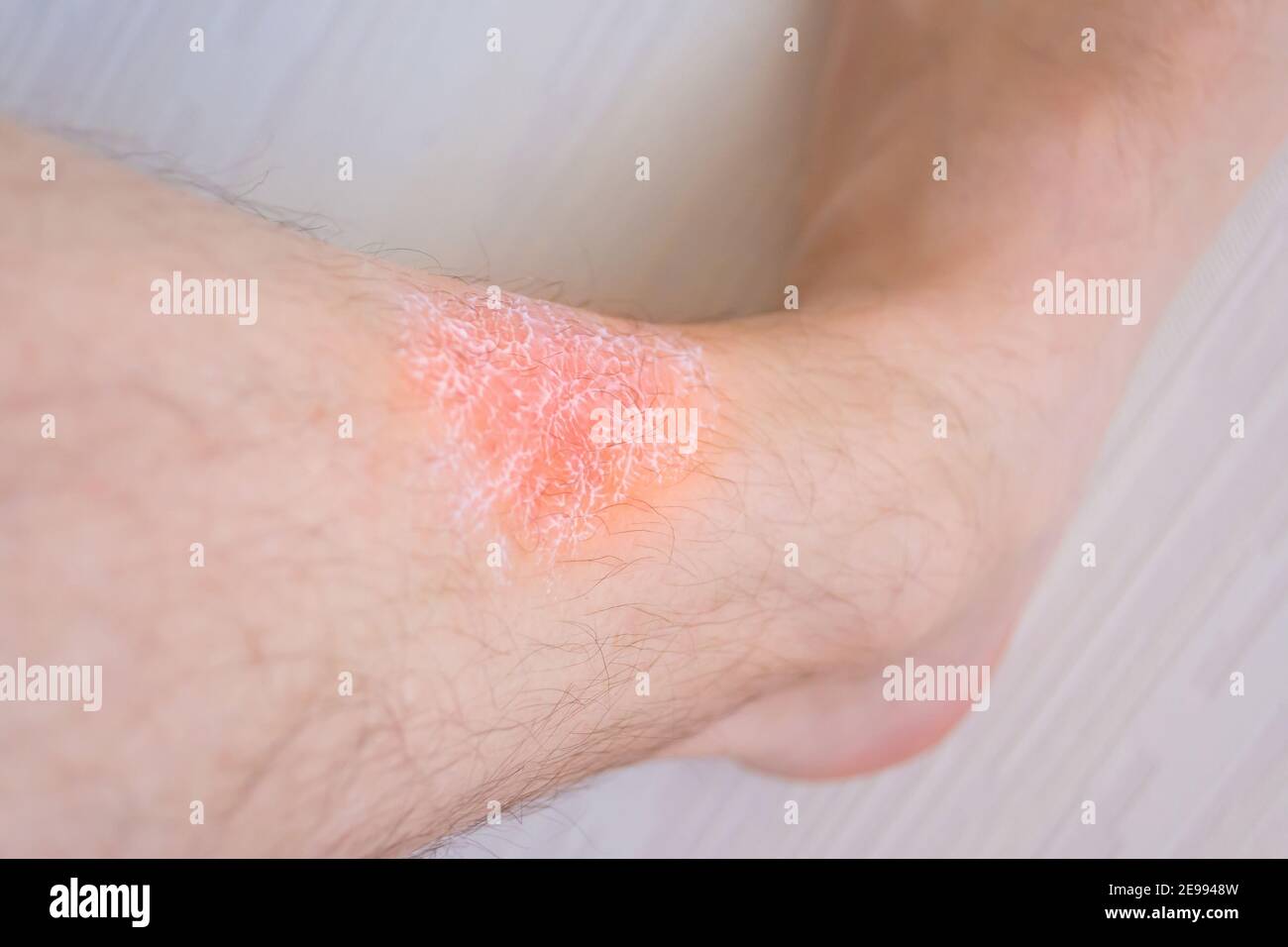 Skin irritation hi-res stock photography and images - Alamy