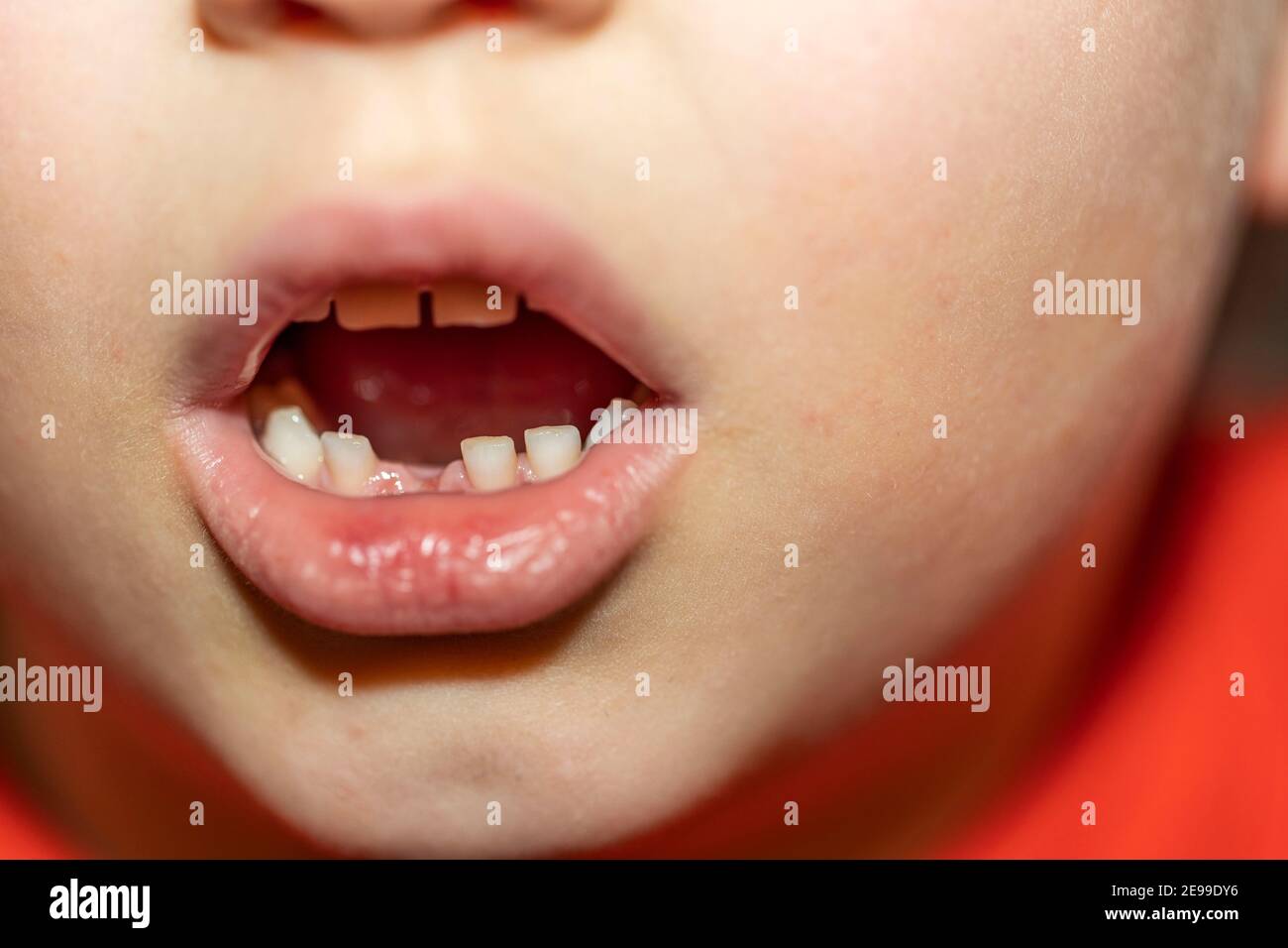 Lost tooth hi-res stock photography and images - Alamy