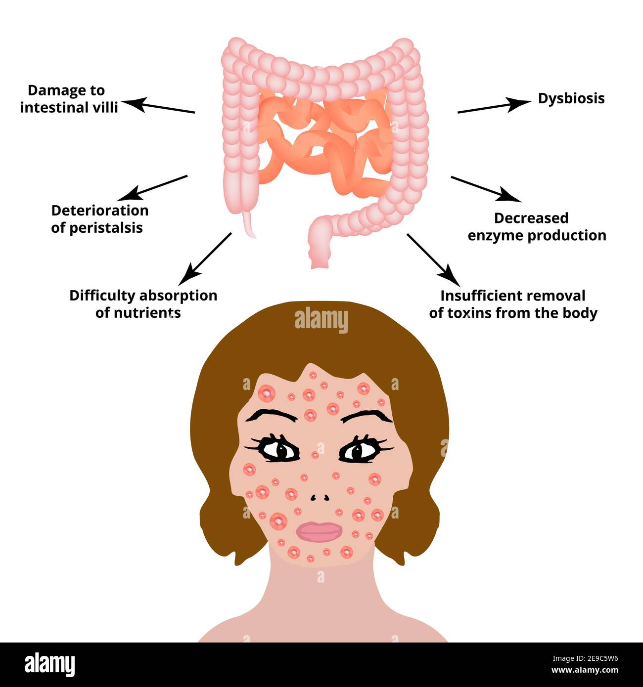 The anatomical structure of the intestine. Bowel diseases affect the ...