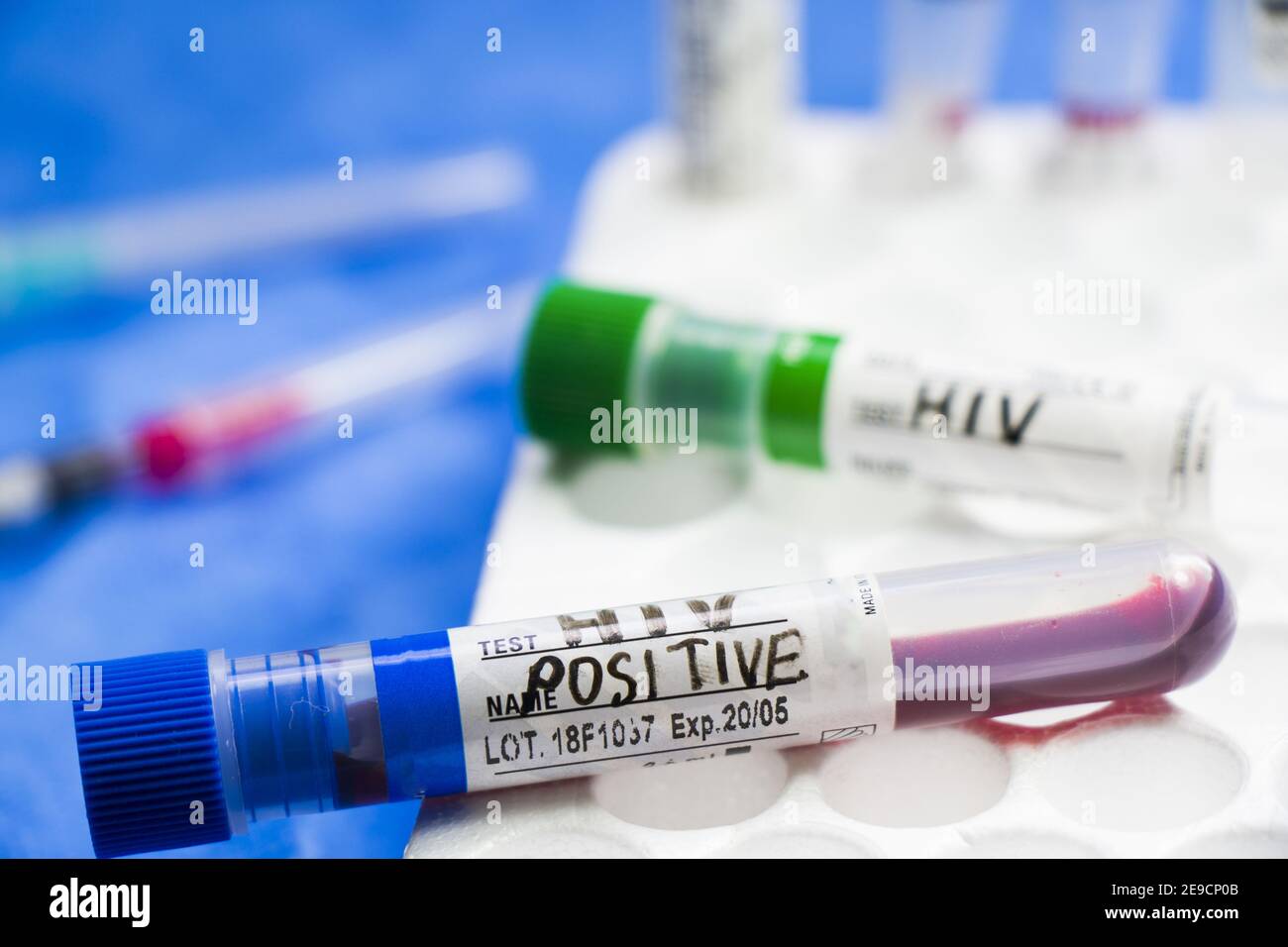 Closeup of HIV POSITIVE test tubes on the table in a laboratory Stock ...