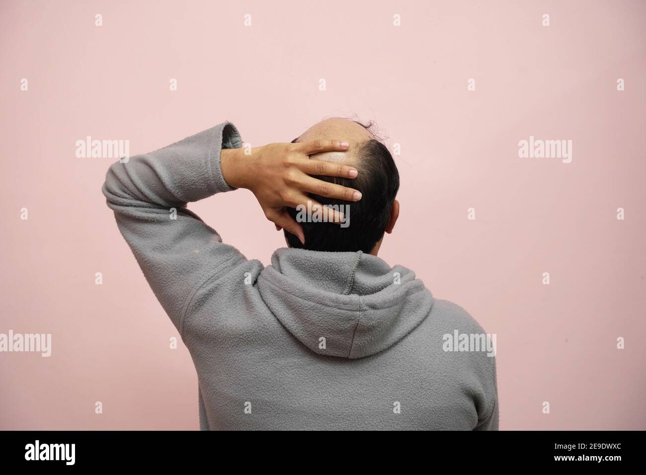 Closeup of a half-bald male with his hand on his head while wearing a ...