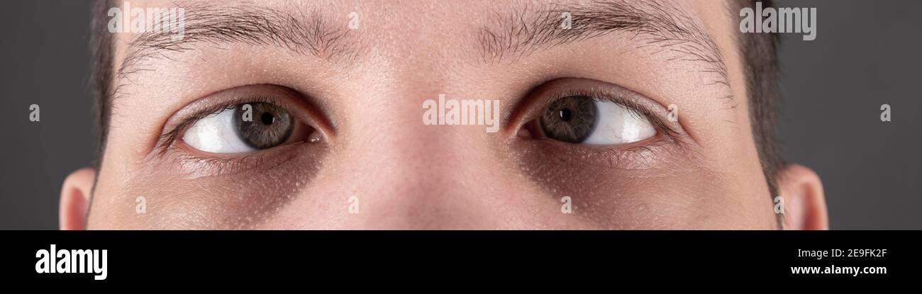 Squint Strabismus High Resolution Stock Photography and Images - Alamy