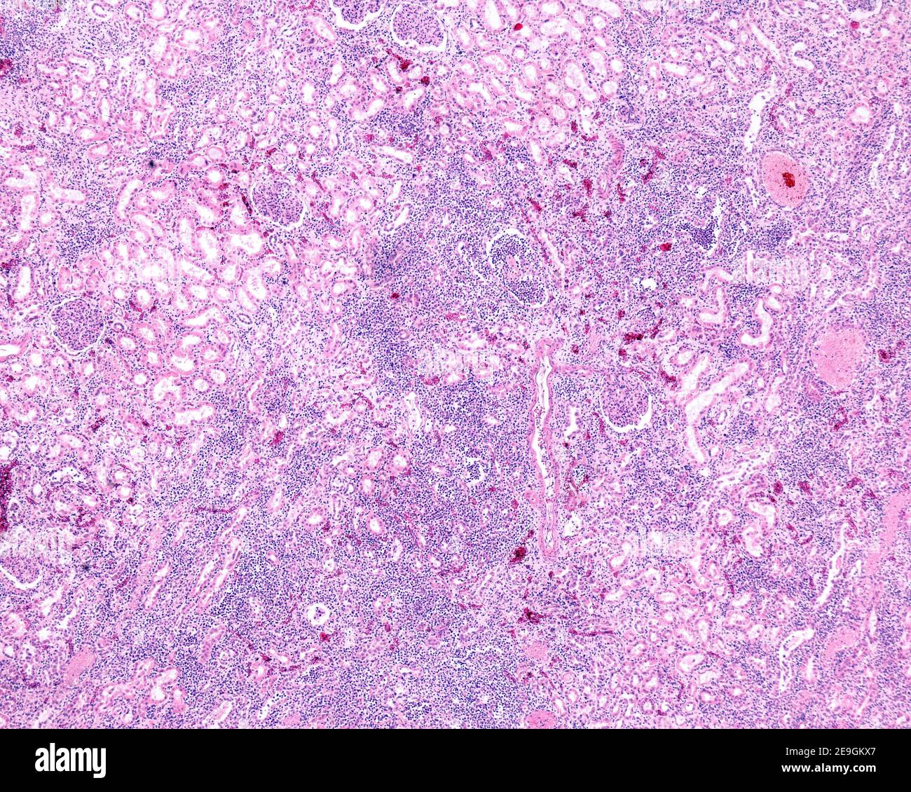 Chronic Pyelonephritis Histology