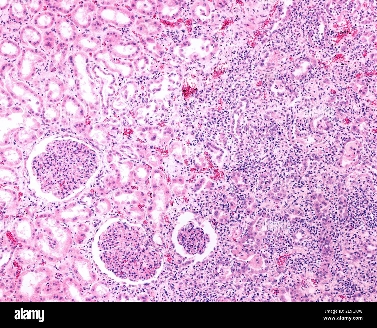 Chronic Pyelonephritis Histology