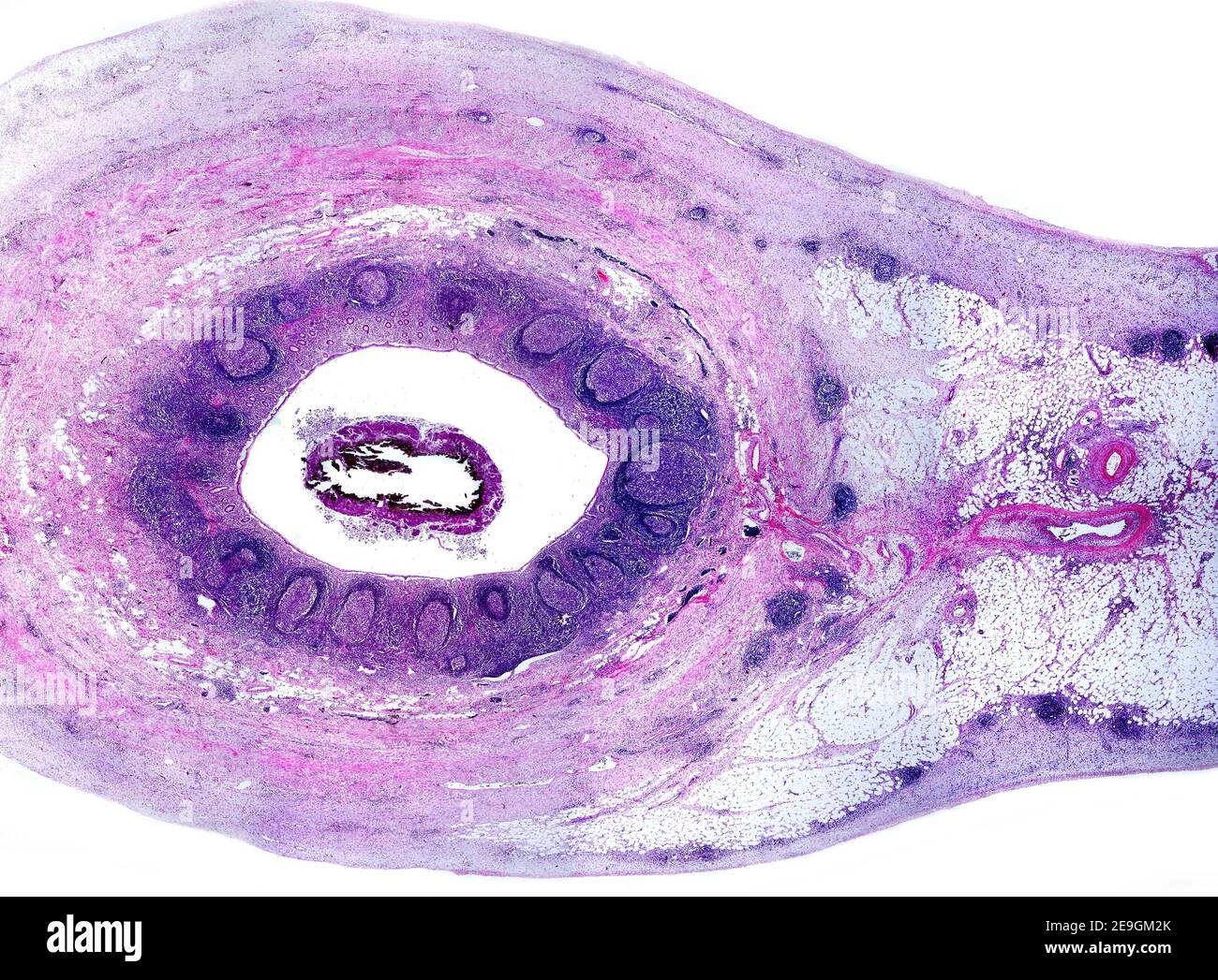 Cross section of a very inflamed human vermiform appendix, showing ...