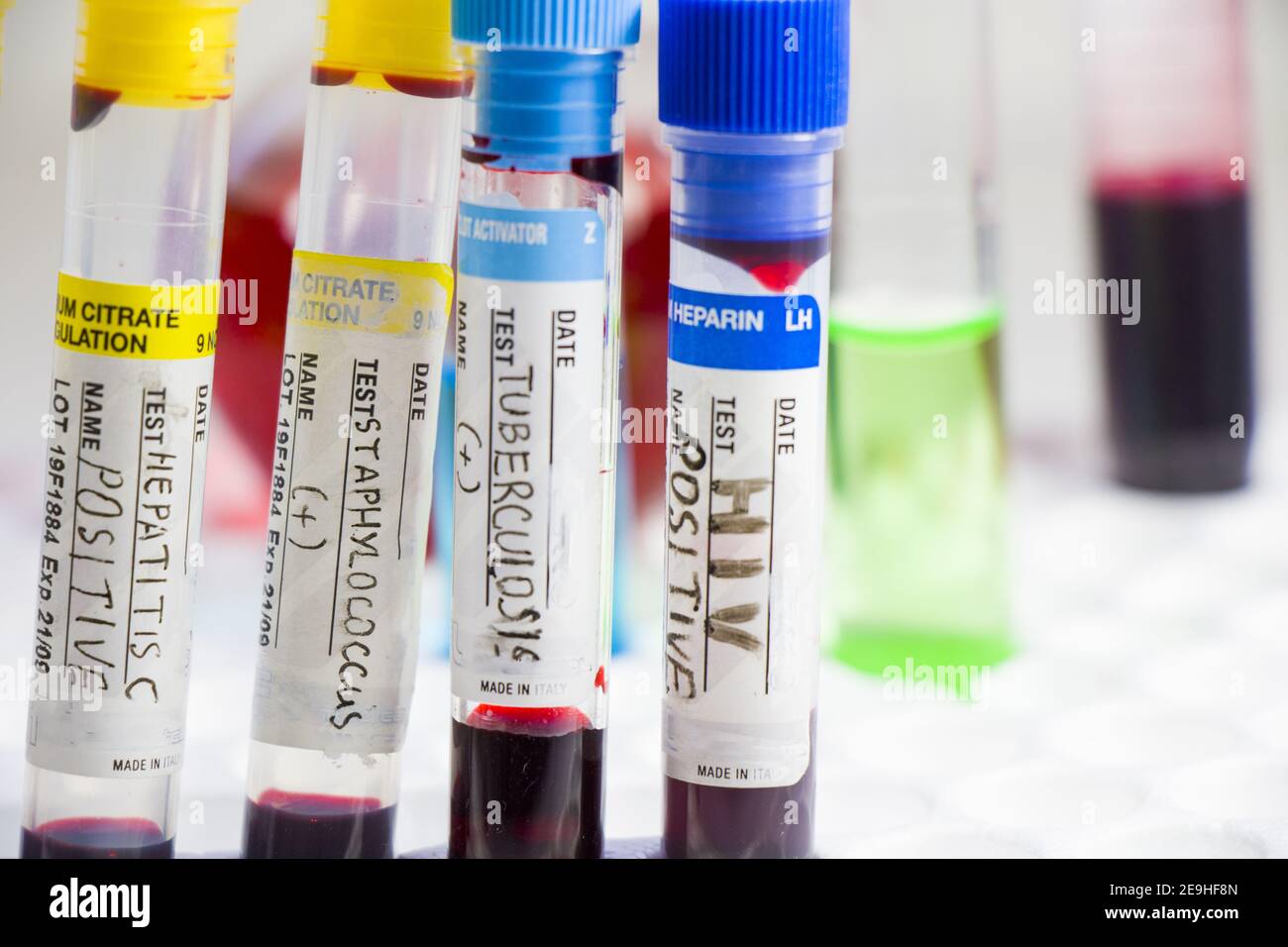 Positive test tuberculosis hi-res stock photography and images - Alamy